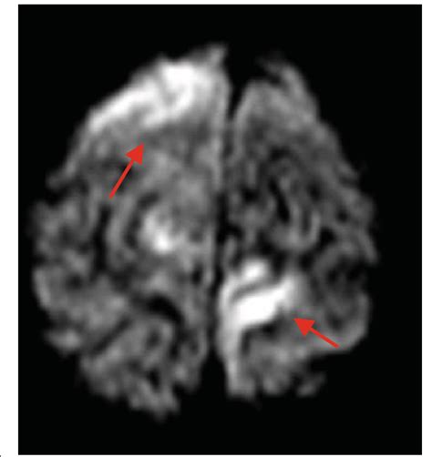 Diffusion Restriction In Bilateral Frontal And Parietal Lobes