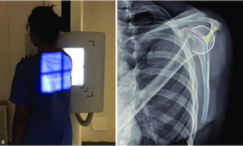 Scapula Lateral View Y Example Of Pa Approach With Napoleon