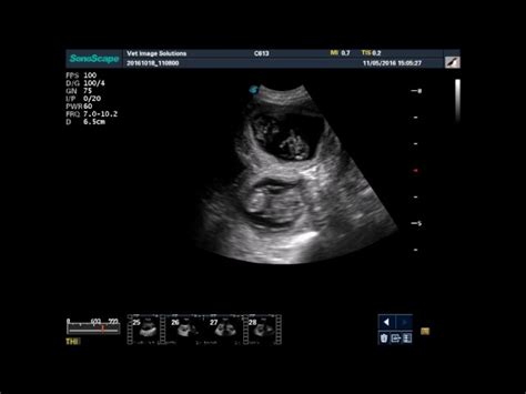 First Trimester Ultrasound Current Uses And Applications 50 Off