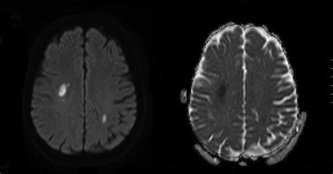 Mri On The Left Side Diffusion Weighted Imaging Dwi On The Right
