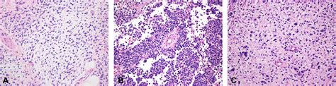 Prognostic And Predictive Biomarkers In Paediatric Solid Tumours