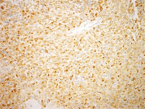 Pleomorphic Dermal Sarcoma Dermatopathology