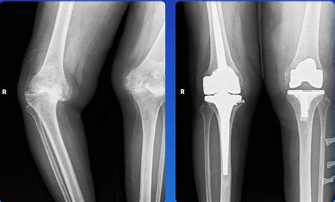 69 Year Old Woman Regains Gait With Hinged Knee Replacement Technique