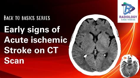 Ct Signs In Acutehyper Acute Stroke In 5 Minshyperdense Mcaloss Of Insular Ribbonprevosts