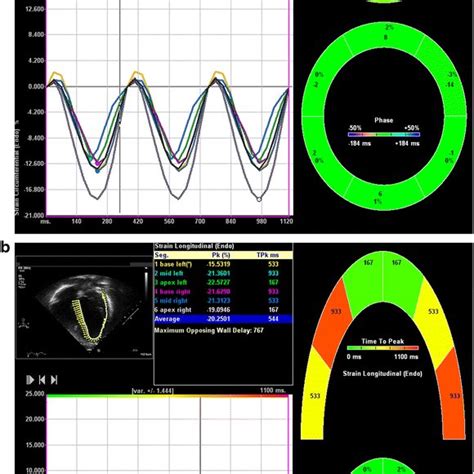 A Example Of Circumferential Strain And Strain Rate Measurement In A