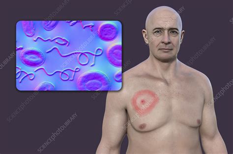 Lyme Disease Illustration Stock Image F0426947 Science Photo