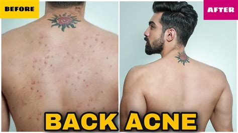 How To Remove Back Acne Fastmen And Womennaturalpimplesback Acne Treatmentdark Spots Hindi