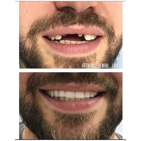 Before And After Twins Dental Tourism