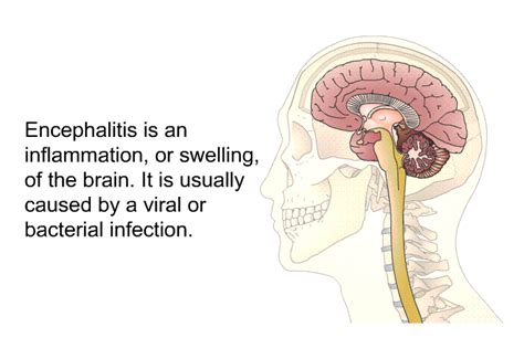 Encephalitis