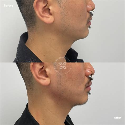 How To Get A Chiseled Jawline Jawline Exercises Jawline 57 Off