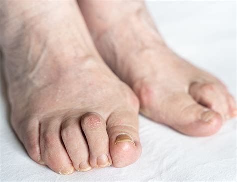 Dont Ignore That Bent Toe — It Could Be A Hammer Toe