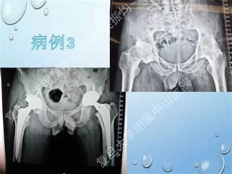 强直髋关节的人工关节置换技巧 好医术早读文章 好医术 赋能医生守护生命