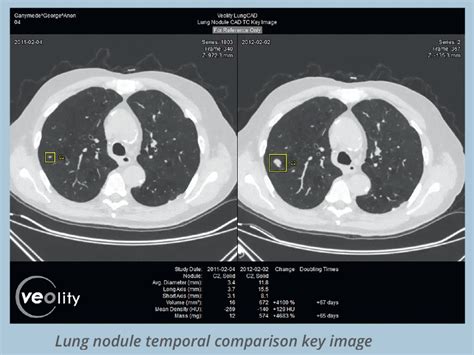 Aplicatie Ai Noduli Pulmonari Veolity Lung Cad Supermedical