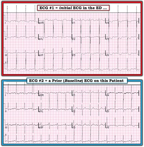 Dr Smiths Ecg Blog Diffuse St Depression And St Elevation In Avr