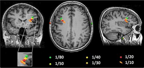 Representative Example Of Iis Source Localizations Performed With The Download Scientific