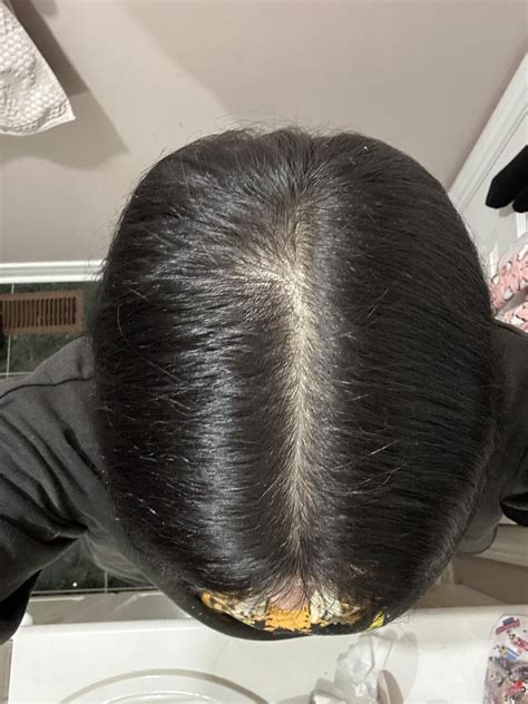 Minoxidil 5 Before And After Pictures R Femalehairloss