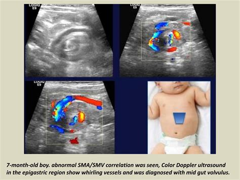 Presentation1 Ultrasound Of The Bowel Loops And The Lymph Nodespptx