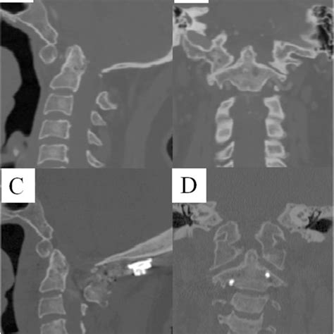 Case A Years Old Female Diagnosed As Atlantoaxial Dislocation Download Scientific