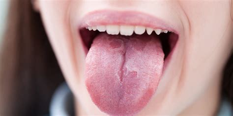 White Spots On Tongue And Sore Lips