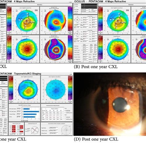 Pdf Clinical Outcomes Of Accelerated Epithelium Off Corneal Collagen Cross Linking For A Case