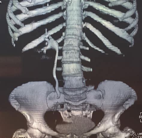 Ct Abdomen Showing Normal Right Pelvicalyceal System And Non Visualized