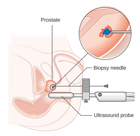 Prostate Biopsy Wikipedia
