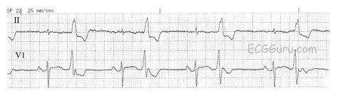 Bigeminy Ecg Guru Instructor Resources