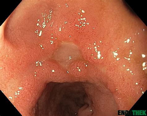 Ulcera Duodeni Endothek