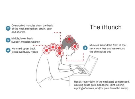 Steroid Injection Rcostochondritis