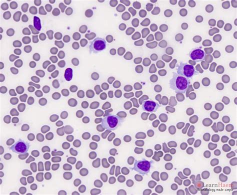 Hairy Cell Variant Leukemia