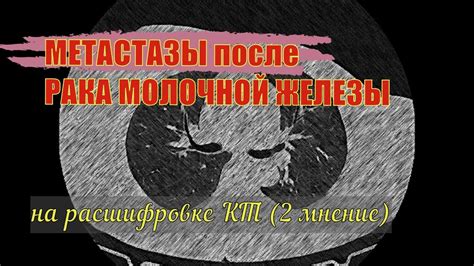 МЕТАСТАЗЫ в легких на КТ РАСШИФРОВКЕ органов грудной клетки 2 мнение после РАКА молочной