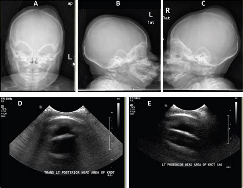 Cephalohematoma Ultrasound