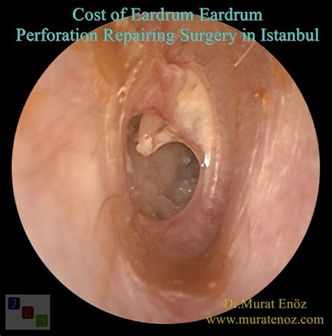Cost Of Eardrum Hole Surgery In Istanbul