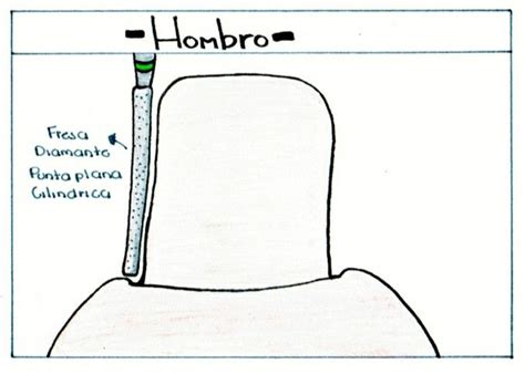 Línea De Terminación En Hombro Protesis Fija Odontología Anatomía Dental