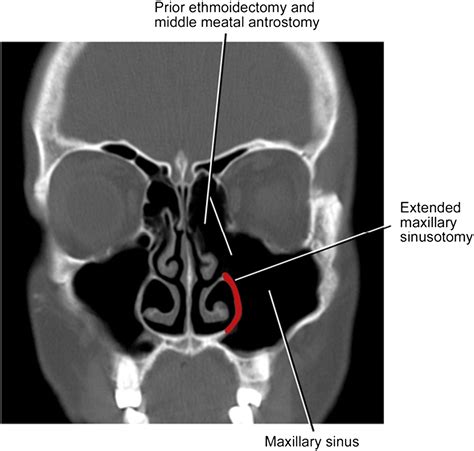 Maxillary Sinus Endoscopy
