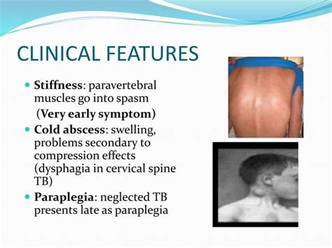 Tuberculosis Of Spinepptx