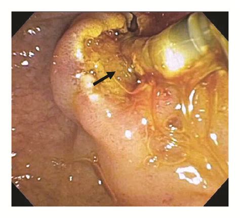 Two Cases Of Acute Cholecystitis And Symptomatic Choledocholithiasis In Two Women Less Than 40