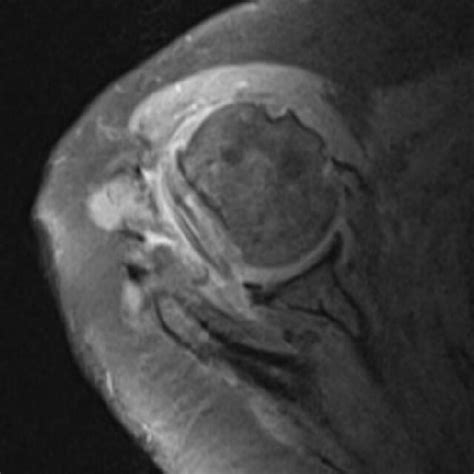 Axial Magnetic Resonance Imaging Demonstrating Retracted Subscapularis
