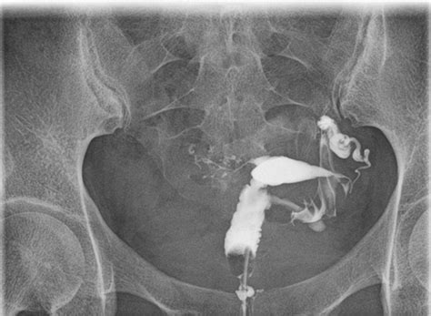 Salpingitis Isthmica Nodosa Radiology Case