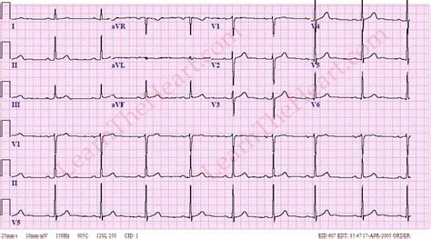 Sinus Bradycardia Ecg 3