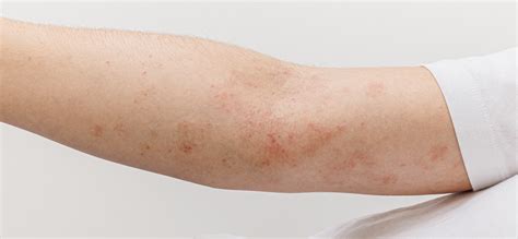Qué es la Dermatitis Atópica y sus causas GalenicumDerma