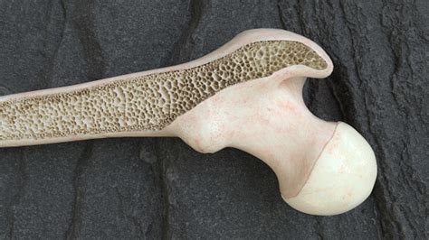 골다공증 허벅지 뼈 내부 3d 렌더링 골다공증에 대한 스톡 사진 및 기타 이미지 골다공증 갯솜뼈 두꺼운 Istock