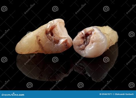 The Removed Teeth Damaged By Caries On A Black Background Macro Stock