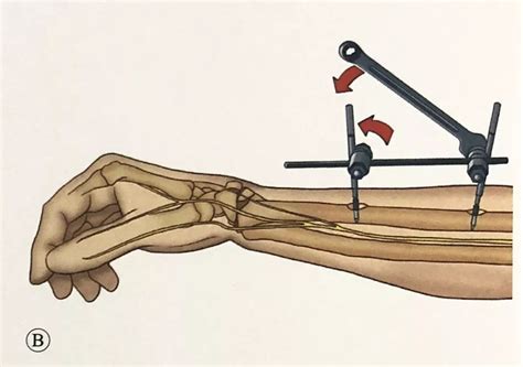 News Distal Radius Fracture Detailed Explanation Of External Fixation Surgical Skills With
