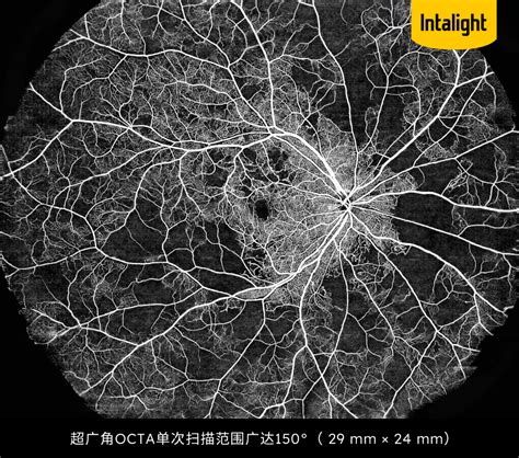 【独家】获华厦眼科战略投资，视微影像品牌升级为“intalight赛炜” 动脉网