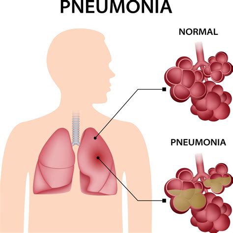 What Is Pneumonia Known For What Is Pneumonia Fact Sheet Kvyoo