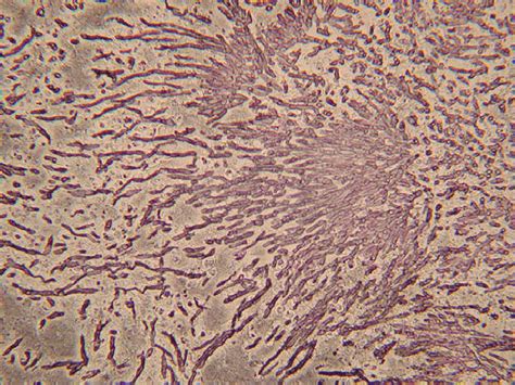 Lungs Aspergilloma Multiple Aspergillus Spp Hyphae Methenamine