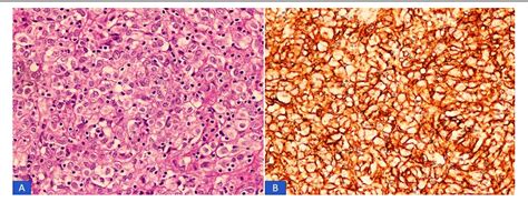 Figure 2 From Extranodal Follicular Dendritic Cell Sarcoma Of The Head