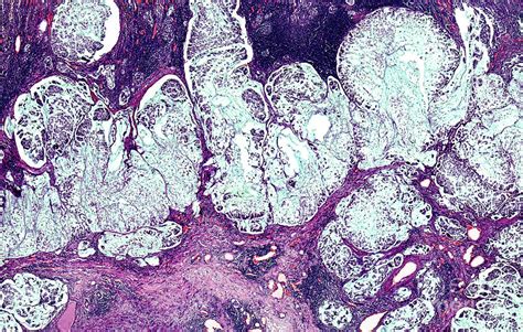 Mucinous Gastric Carcinoma Photograph By Nigel Downerscience Photo