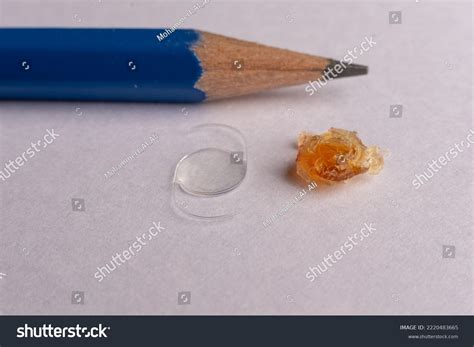 Posterior Capsular Opacification Over 14 Royalty Free Licensable Stock